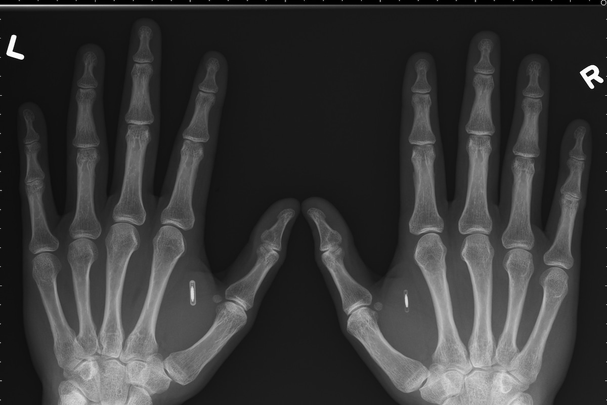Meet the man who stuck a microchip in his hand | Dazed