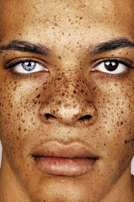 Exploring the beauty and shame of freckles | Dazed