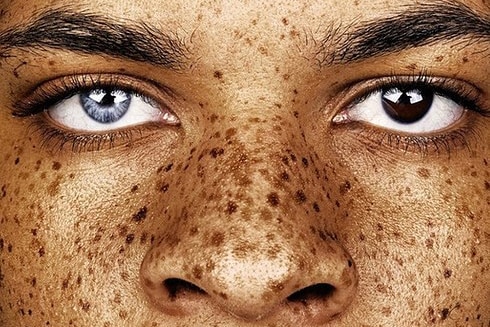 Exploring the beauty and shame of freckles | Dazed