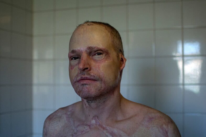Documenting the scars worn by people who escaped death | Dazed