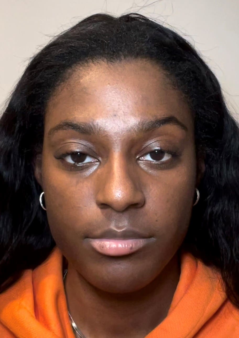 I injected salmon sperm into my face – these were the results | Dazed